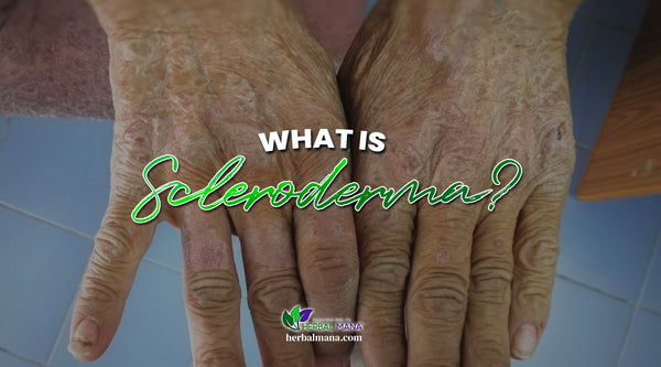 What Is Scleroderma? Symptoms, Natural Remedies & More!